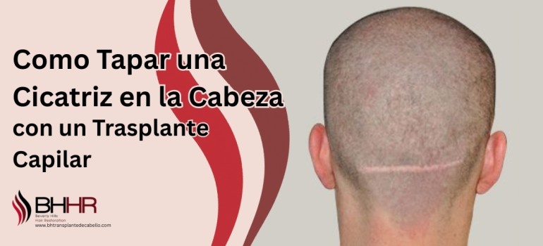 Como Tapar una Cicatriz en la Cabeza | BH Transplante De Cabello